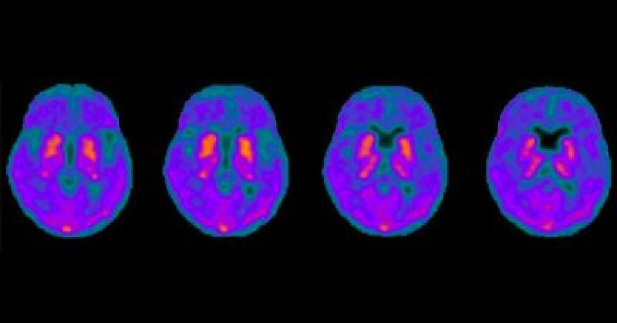 PET Imaging for Parkinson's Research | Pacific Radiology