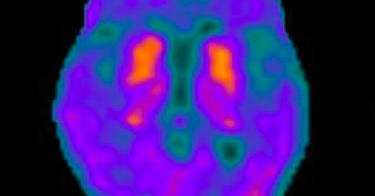 Neurodegenerative Research | Pacific Radiology Studies