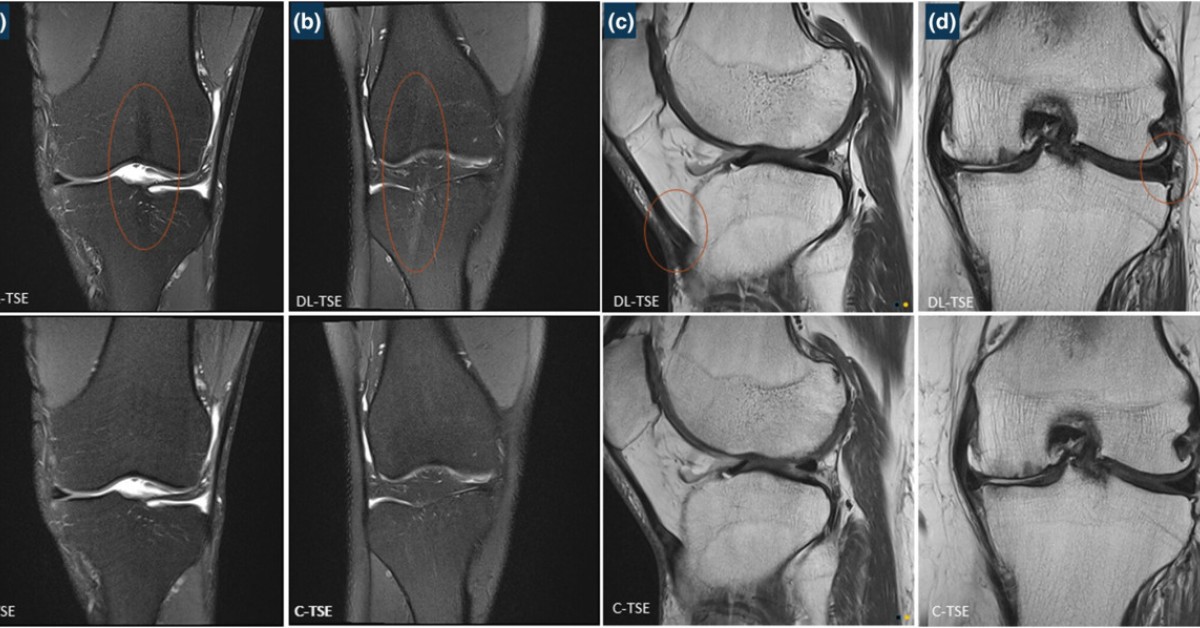 Deep Learning TSE Imaging | Enhanced Knee Scans